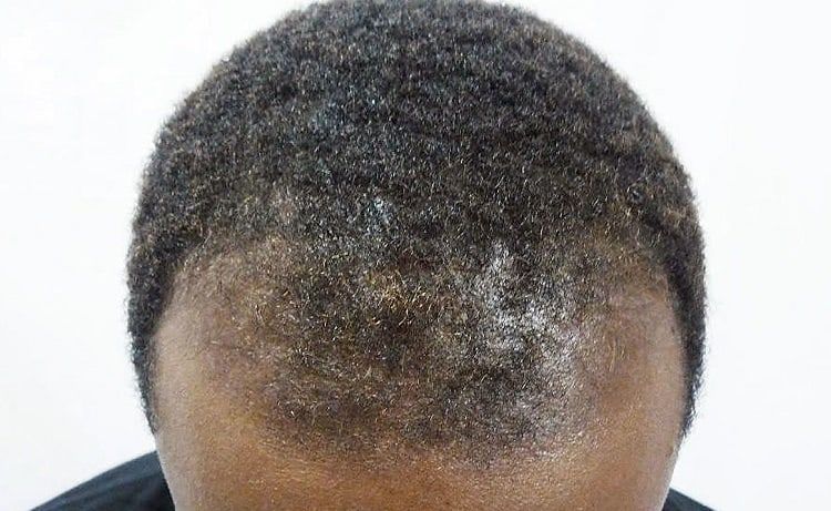 Doctor shares tips to prevent or reduce balding in men | The Ghana Report Doctor shares tips to prevent or reduce balding in men | The Ghana Report